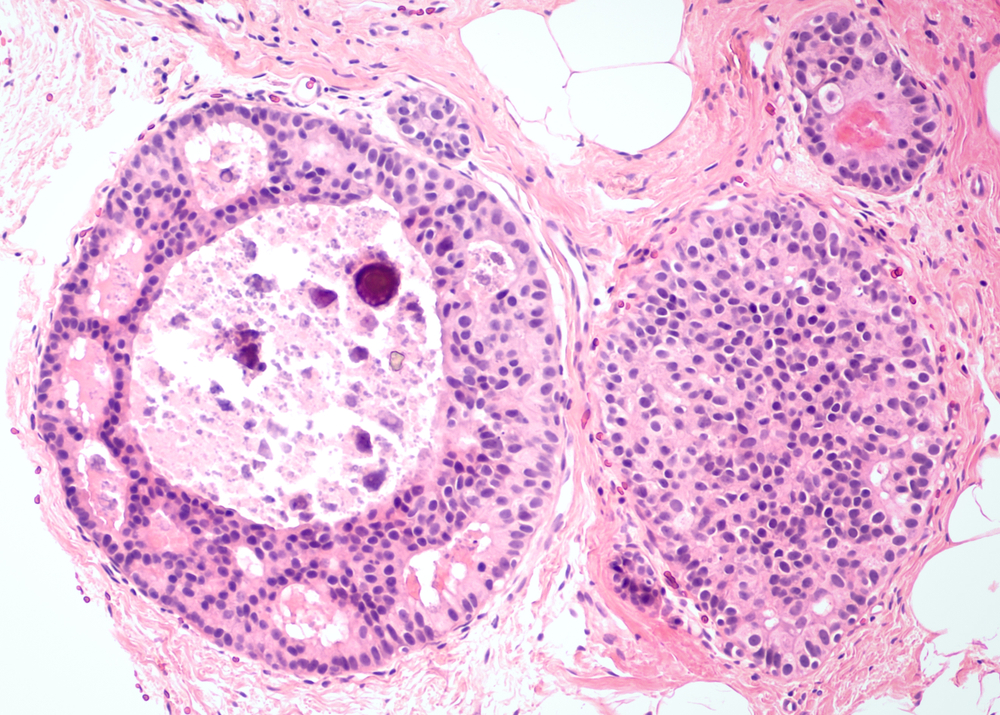 Identificate le cellule anti-terapie del tumore al seno - Federazione ...